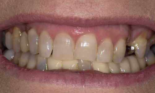 Cosmetic Dentistry Smile Gallery with Before & After Photos