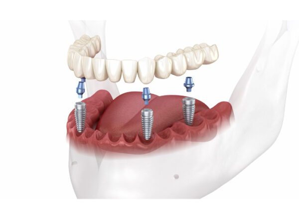 Fixed Hybrid Dentures at Palmetto Smiles | Dentists in Florence SC